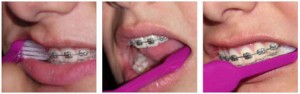 Braces Care | Brisbane | Orthosmile
